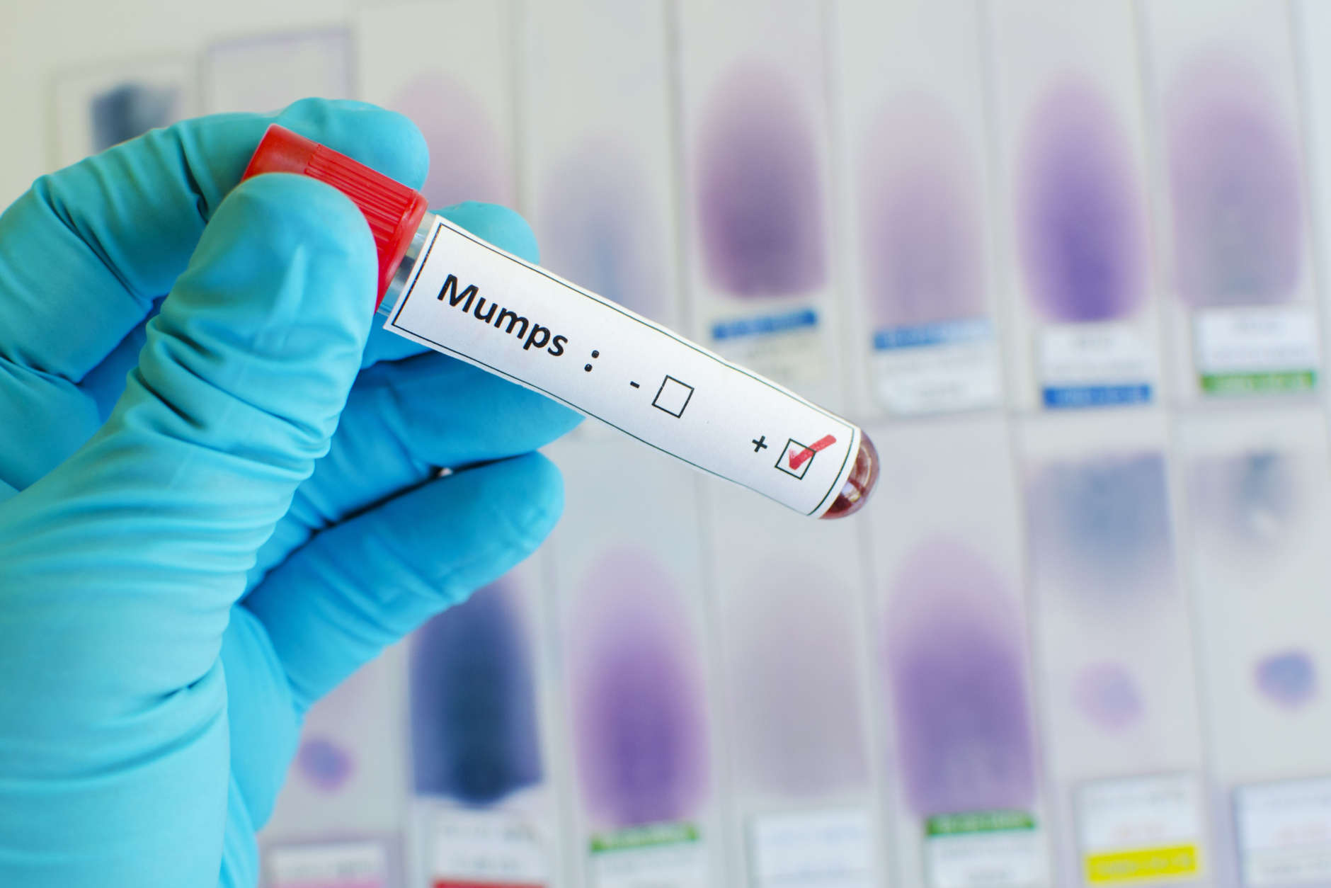 Health experts: Mumps vaccine weakens over time - WTOP News