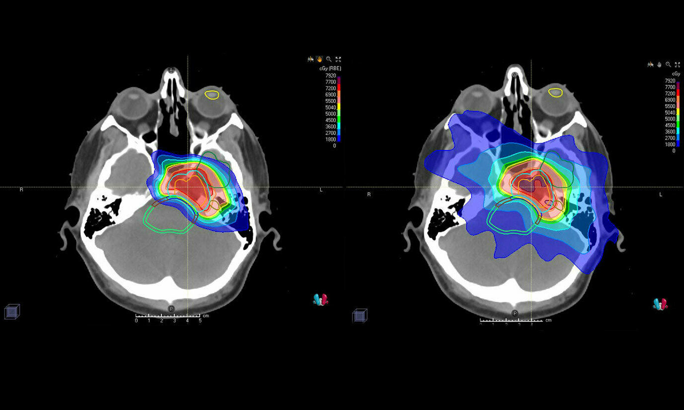 Proton therapy delivers targeted treatment to brain and spinal cord ...